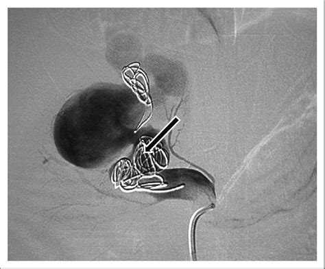 Angiogram After The First Coil Embolisation Demonstrating The First Download Scientific Diagram