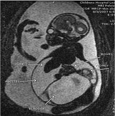 Prune Belly Syndrome Associated With Cloacal Anomaly Patent Urachal