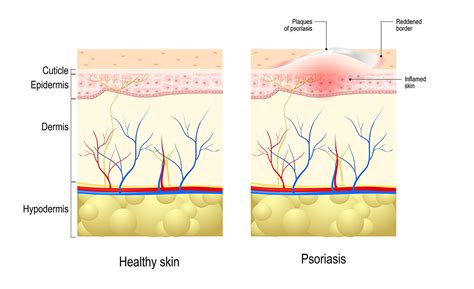 Black Skin Missed Diagnosis The Psoriasis Problem We Need To Talk About Black Health Matters