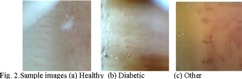 Figure 1 From Classification Of Nailfold Capillary Images Using Wavelet And Discrete Cosine