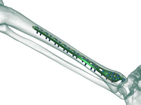 True Lock Distal Tibia Medial Anatomic Plate Truemed Medikal