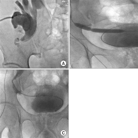A And 1b Retrograde And Antegrade Pyelogram Showing Long Segment Download Scientific Diagram