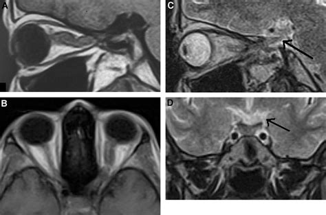 A T 1 Sagittal Mri Shows A Hypointense Lobulated Left Optic Nerve