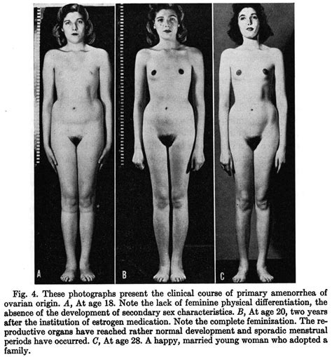 R Cistimelines A 1930s Timeline Of Breast Development And