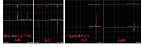 Figure 1 From Intraoperative Neuromonitoring In Spine Deformity Surgery Modalities Advantages