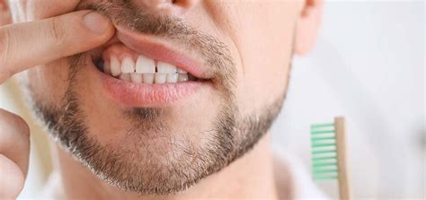 Cómo Saber Si Necesito Un Tratamiento Periodontal Síntomas Y Opciones