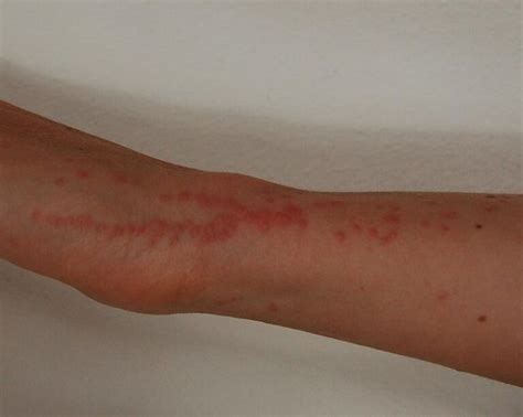 Chigger Bites Vs Bed Bug Bites How To Tell Them Apart