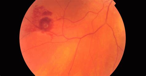 Management Of A Retinal Arterial Macroaneurysm The Journal Of Medical Optometry Jomo