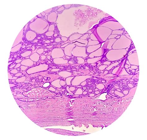 Premium Photo Synovial Sarcoma Histology Image Analyzed By Microscope