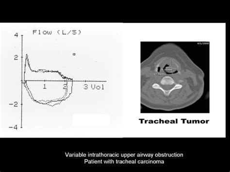 Disorders Of The Central Airways And Upper Airway Obstruction Pulmonology Advisor