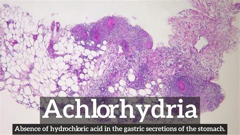 How Does Achlorhydria Look How To Say Achlorhydria In English What Is Achlorhydria Youtube
