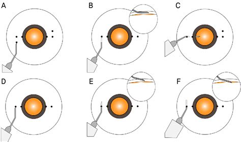 Figure 2 From Short Term Clinical Outcomes After Flanged Intrascleral
