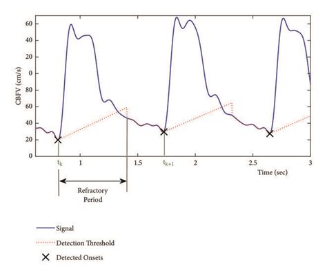 An Example Of Pulse Onset Detection Using Asgari Method Download