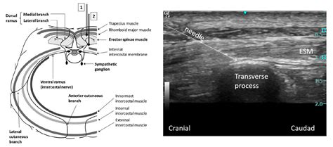 Unilateral Erector Spinae Plane Block As Adjuvant For Open Repair Of Thoracoabdominal Aortic