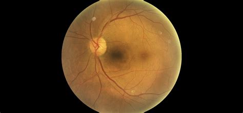 Odir Model Object Detection Dataset V3 Glaucoma By Saunak359