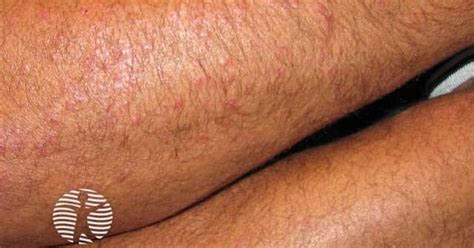 Polymorphic Light Eruption Image