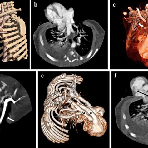 Patient 2 Ct Angiography In A 3 Day Old Girl With Ectopia Cordis And Download Scientific