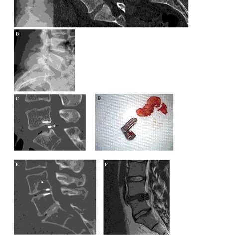 The 30 By Width Glenoid Defect Geometry The Glenoid Center Was