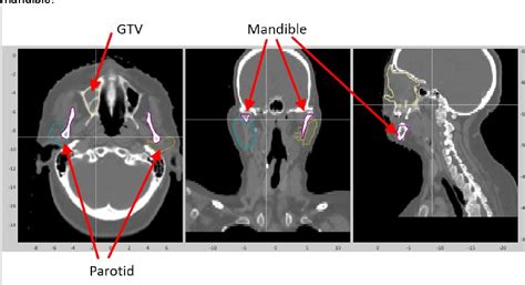 Classification Of Anatomic Structures In Head And Neck By Ct Based Classification Of Anatomic Structures In Head And Neck By Ct Based