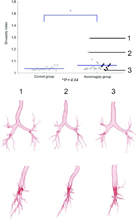 Sinuosity Index SI Of The Control And Acromegalic Groups In The Download Scientific Diagram