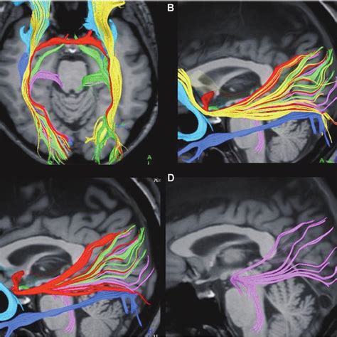 Fractional Anisotropy Fa Maps Displayed As Color Orientation Maps