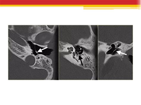 Tympanosclerosis Pptx