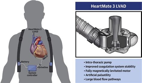 Trends And Outcomes Of Left Ventricular Assist Device Therapy Jacc
