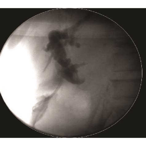 Eus Bd In A Patient With A Periampullary Tumor With Unidentifiable Download Scientific Diagram