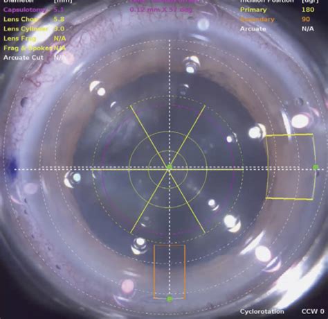 Crstoday Is A Femtosecond Laser Really Useful For Nuclear Fragmentation