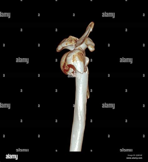 Computed Tomography Volume Rendering Examination Of The Shoulder 3d Rendering In Patient