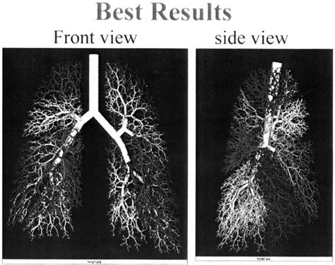 Resulting 3d Airway Tree With The Best Choices Of Parameters Left