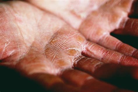 Laboratory Markers Aid In Evaluating Atopic Dermatitis