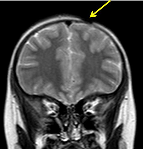 Linear Scleroderma Image