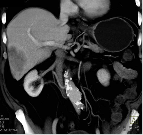 Intrahepatic Cholangiocarcinoma Liver Case Studies Ctisus Ct Scanning