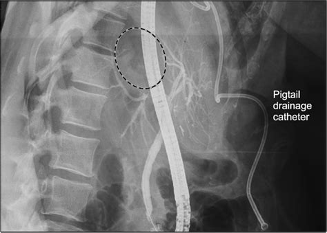 Endoscopic Retrograde Cholangiography Depicting Normal Findings Apart Download Scientific