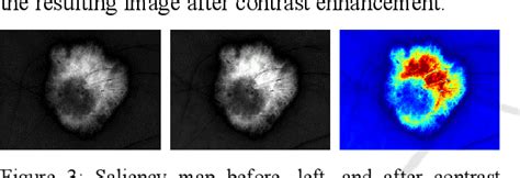 Figure 1 From Automatic Skin Lesion Segmentation Based On Saliency And Color Semantic Scholar