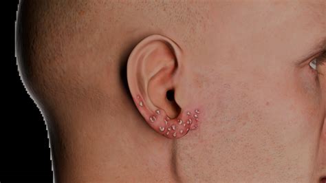 Infectious Diseases Of The Auricle Etiology Diagnosis And Treatment