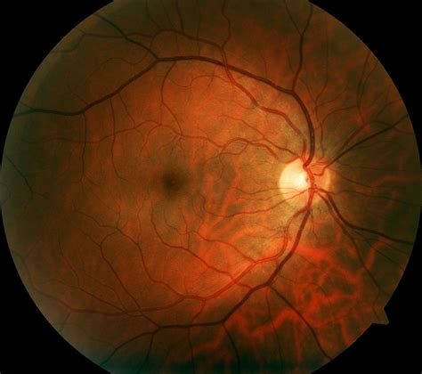 retina anatomy function and treatment