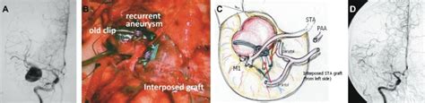 Treatment Of Recurrent Intracranial Aneurysms After Neck Clipping Novel Classification Scheme