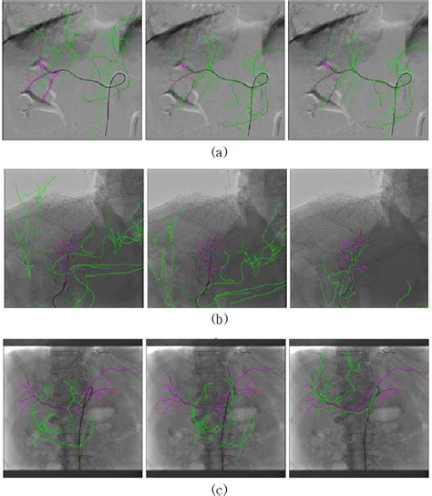 Figure 1 From Locally Adaptive 2d 3d Registration Using Vascular Structure Model For Liver