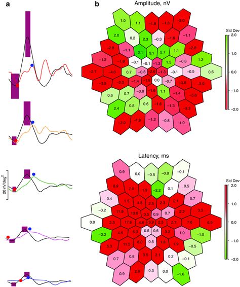 19 Multifocal Erg Findings In Occult Macular Dystrophy Omd The Mferg Download Scientific