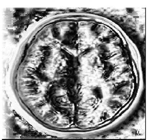figure 4 from enhancement of mri brain images with histogram
