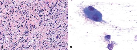Sarcomas And Sarcomatoid Neoplasms Of The Lungs And Pleural Surfaces Clinical Tree