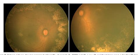 Figure 1 From Visual Acuity And Electroretinography Findings 3 ½ Years After The First