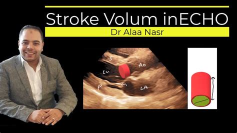 Stroke Volum And Vti Calculation In Echo Dr Alaa Nasr 2023 Youtube