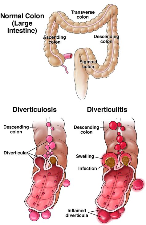 Diverticulitis Aga Gi Patient Center