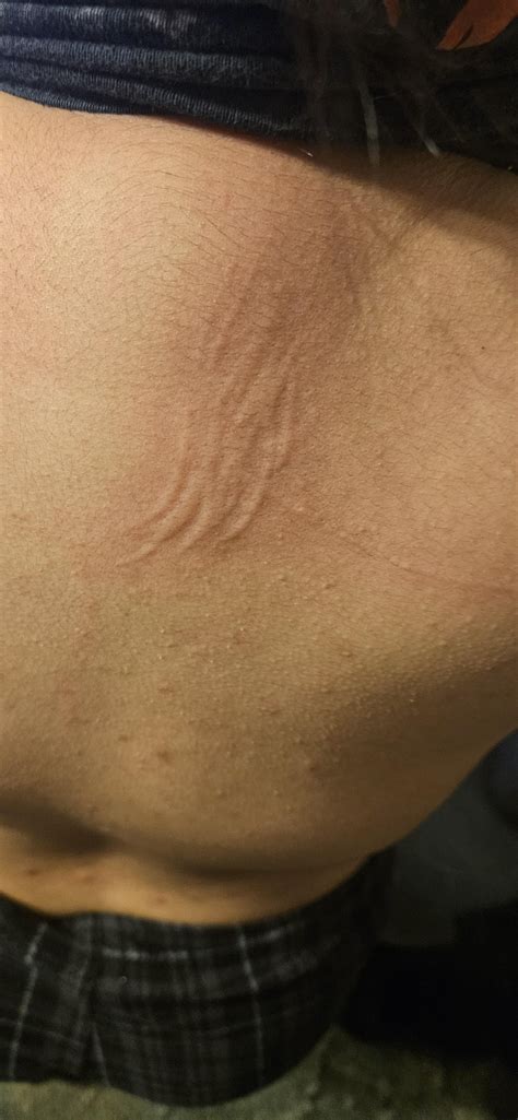 Fiance Keeps Getting Weird Inflamed Marks On Body And After A Few Times