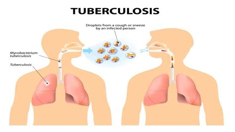Tuberculosis By Khushboopdf