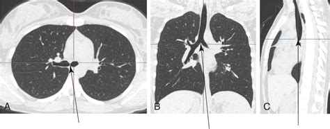 Using Reactive Machine AI To Derive Quantitative Lung CT Metrics Of