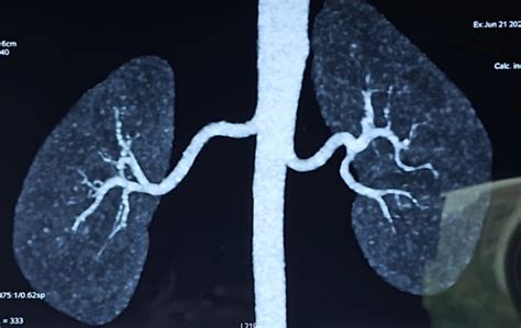 Technical Aspects Of Right Laparoscopic Donor Nephrectomy